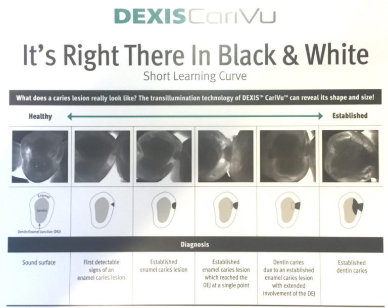 CariVu- Caries Detection Device | Juanita Family Dentistry